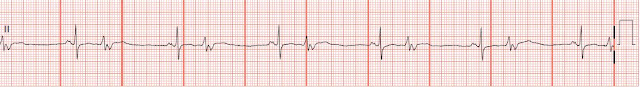 EKG Rhythm Strips: Bigeminy, Trigeminy, Quadrageminy