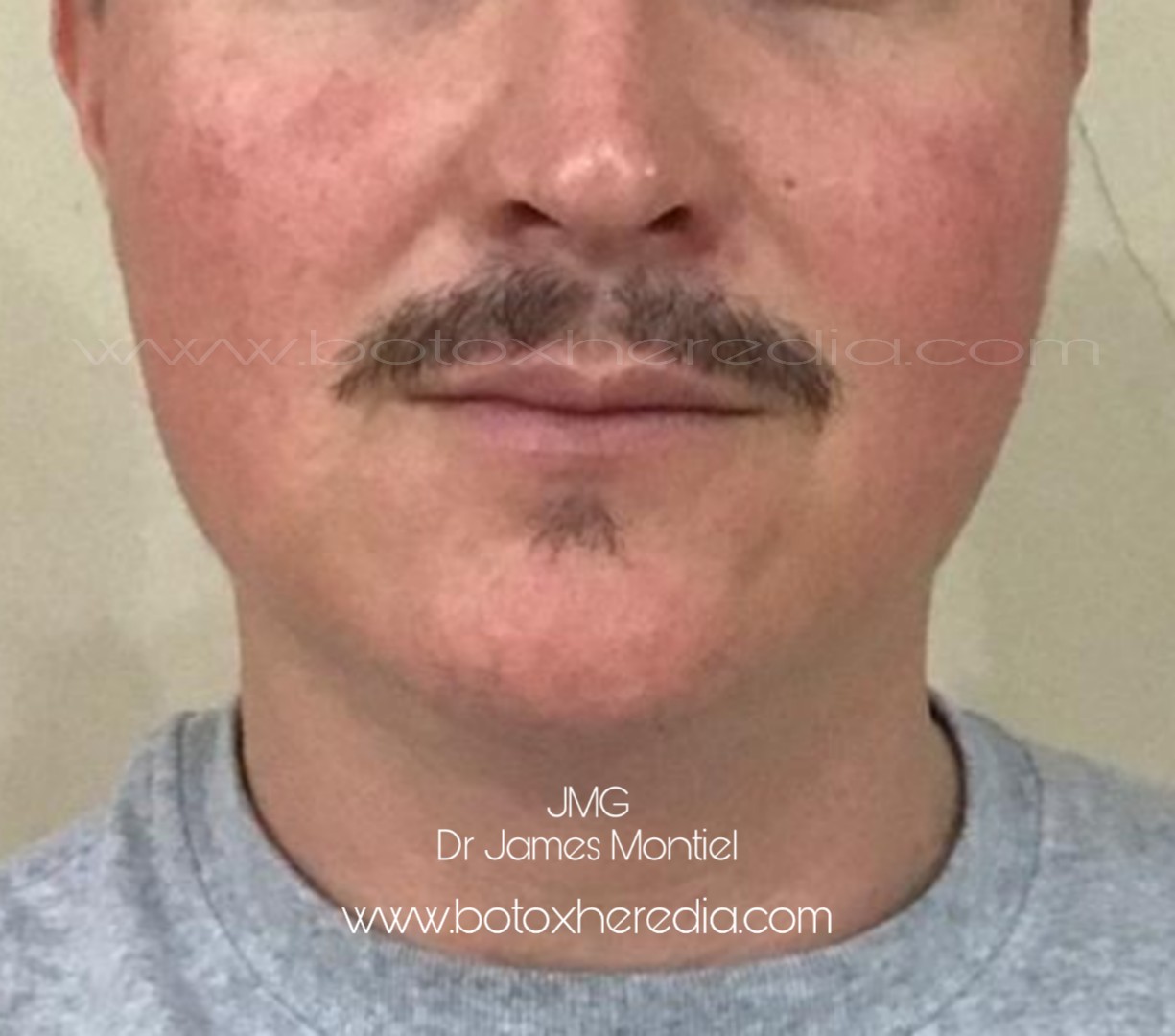 Botox, Acido Hialurónico, Bichectomia, Invisible Touch Hilos Pdo