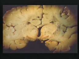 Medical Treatment Pictures-for Better Understanding: Kernicterus