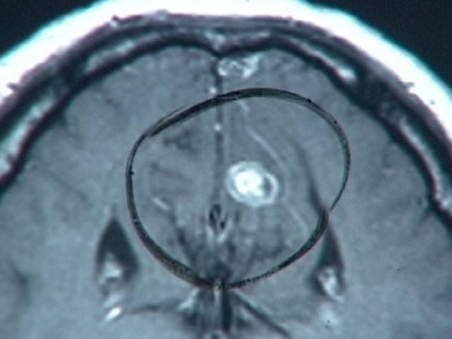 Clinical Symptoms Of Brain Tumors | Chronic Sore Throat