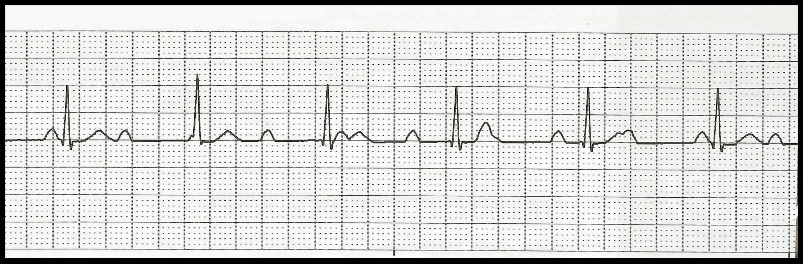 EKG Rhythm Strip Quiz 206