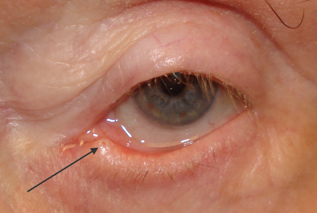 The Patient's Guide to Artificial Tears - Eyedolatry