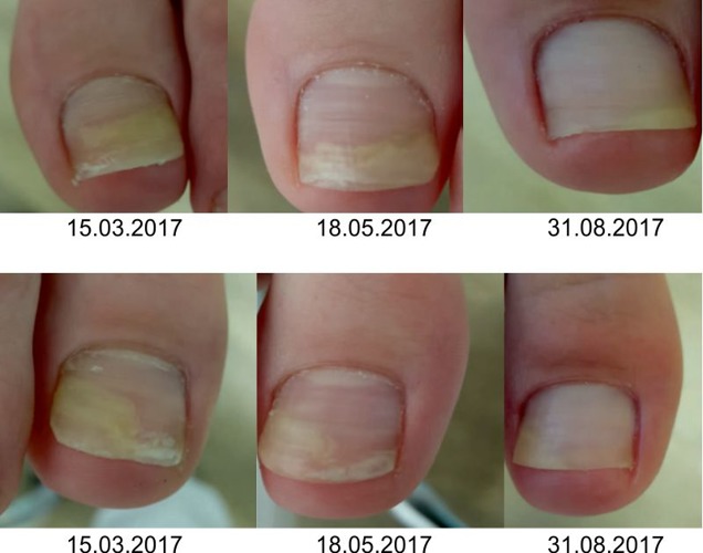 Mani Pedi Studio: Na onycholizę... Nie tylko ONYGEN! Pharm Foot Onyplasma