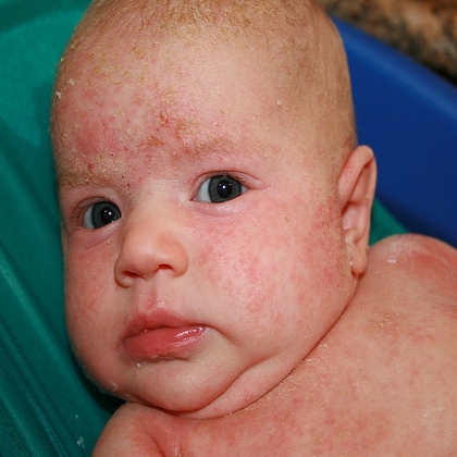 Baby Acne Cure and Treatment: Baby Eczema Pictures : What Looks Like ...