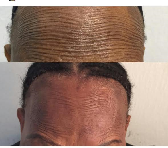 Liposuction, Stretch marks, Gluthathione, Botox, Derma Filer, Hair loss ...