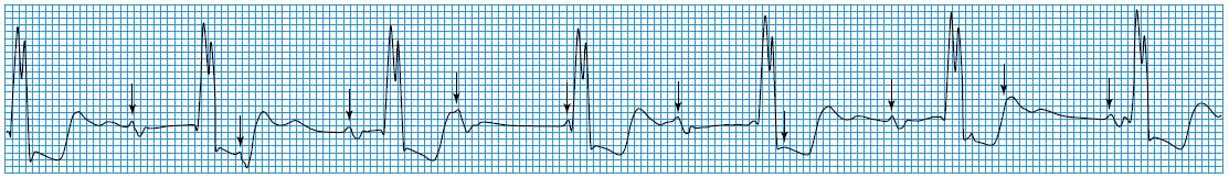 Third degree atrioventricular block / Complete heart block - ECG