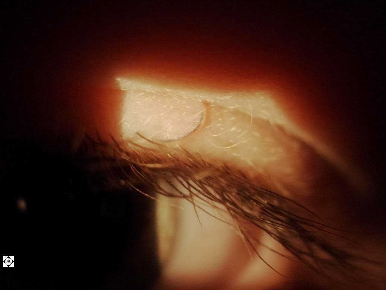 Sonoran Desert Eye Center: INGROWN EYELASH