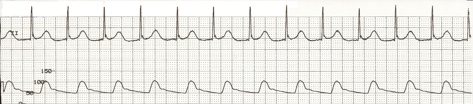 EKG Rhythm Strips 14: Junctional Rhythms