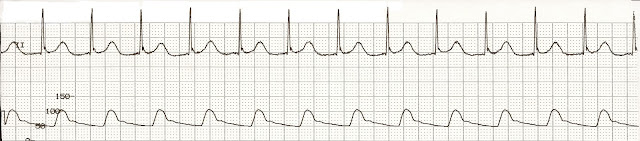EKG Rhythm Strips 14: Junctional Rhythms