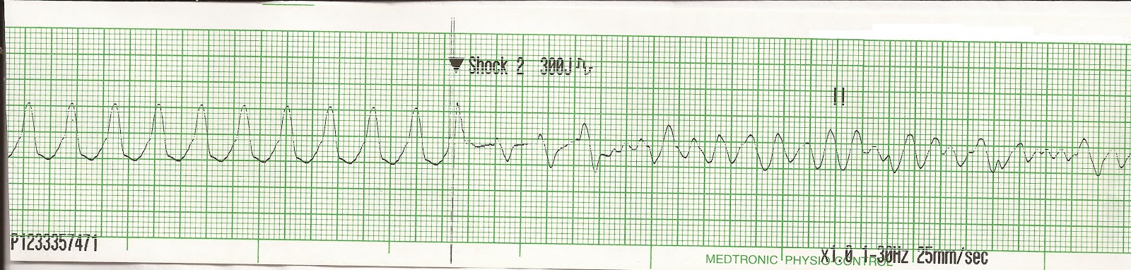 Float Nurse: Pulseless VF/VT