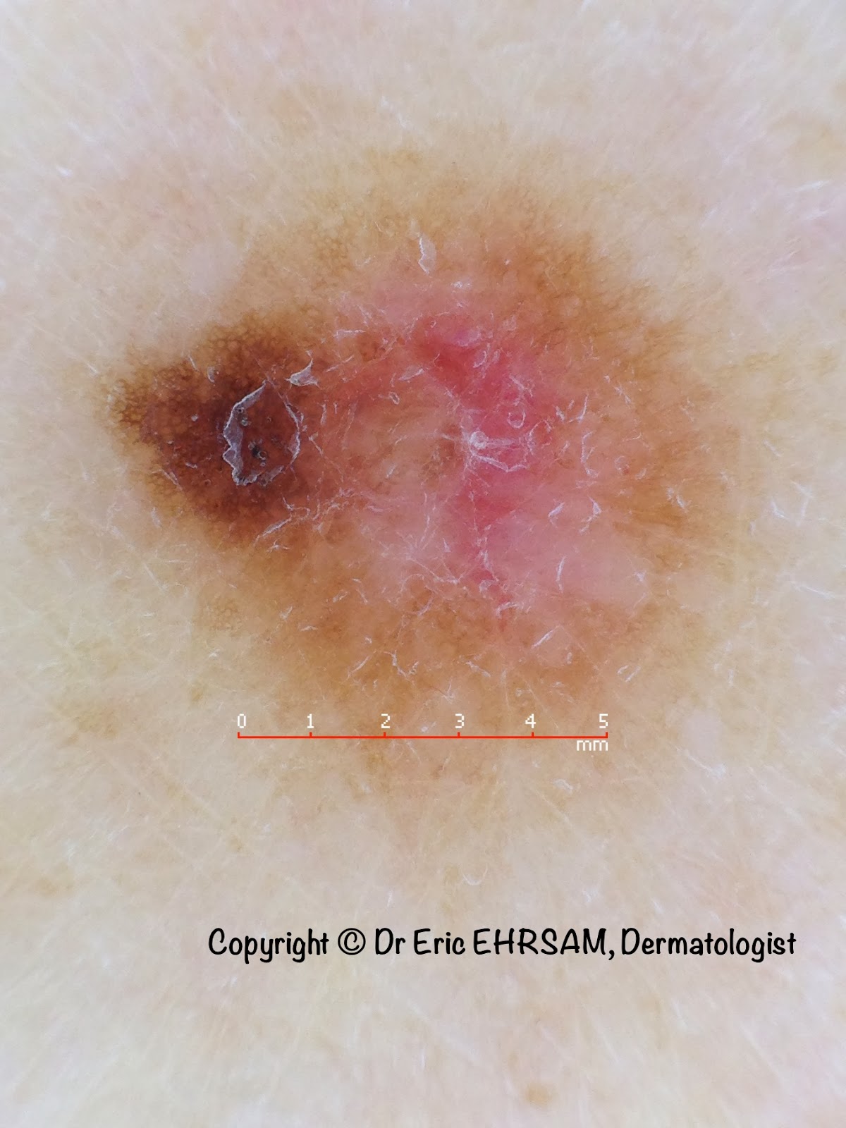 dermoscopy: Melanoma