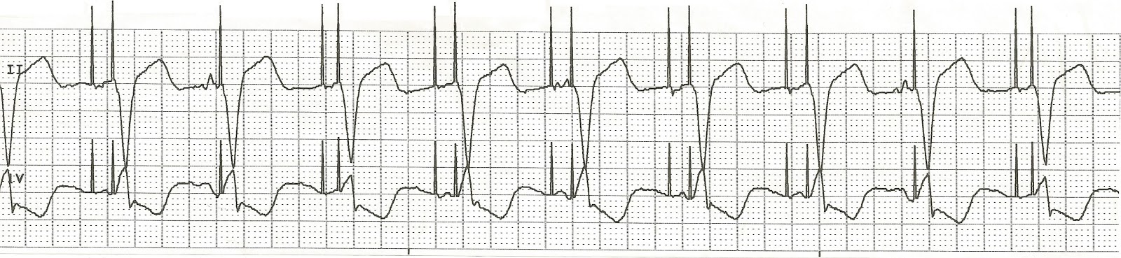 Practice ECG Rhythm Strips 96