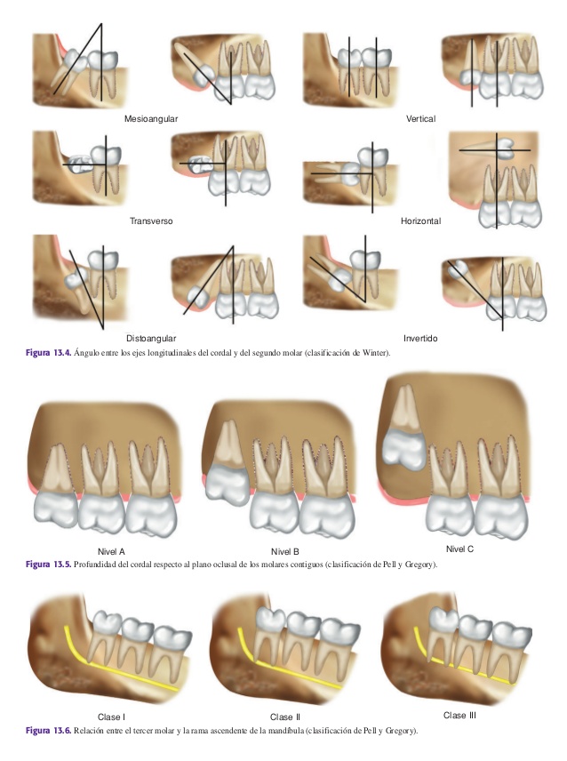Exodoncia terceros molares inferiores y superiores