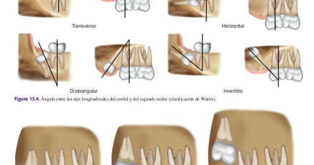 Exodoncia terceros molares inferiores y superiores