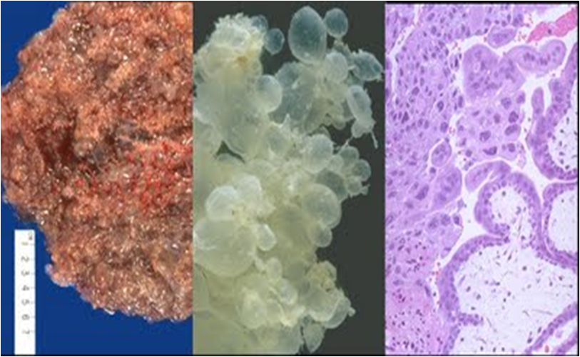 Enfermedad Trofoblastica Gestacional | "Obstetricia I"
