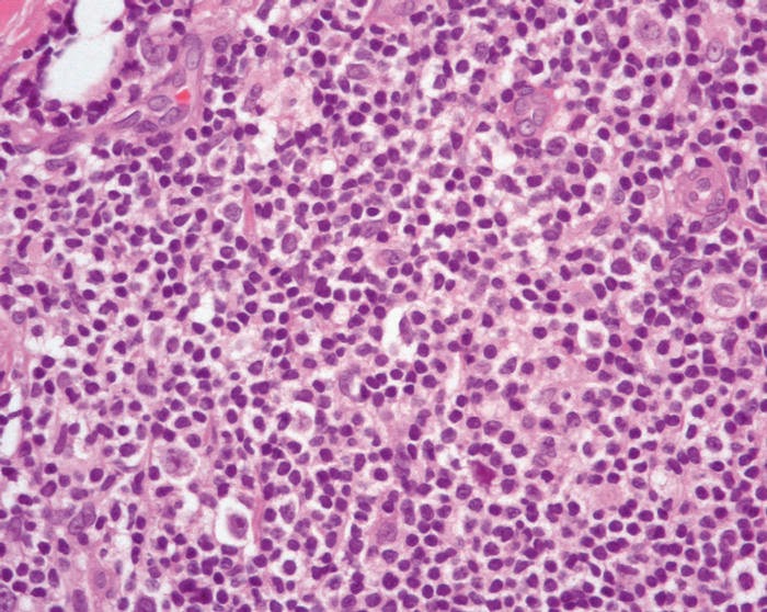fichero hematologia: Linfoma de células B de la zona marginal