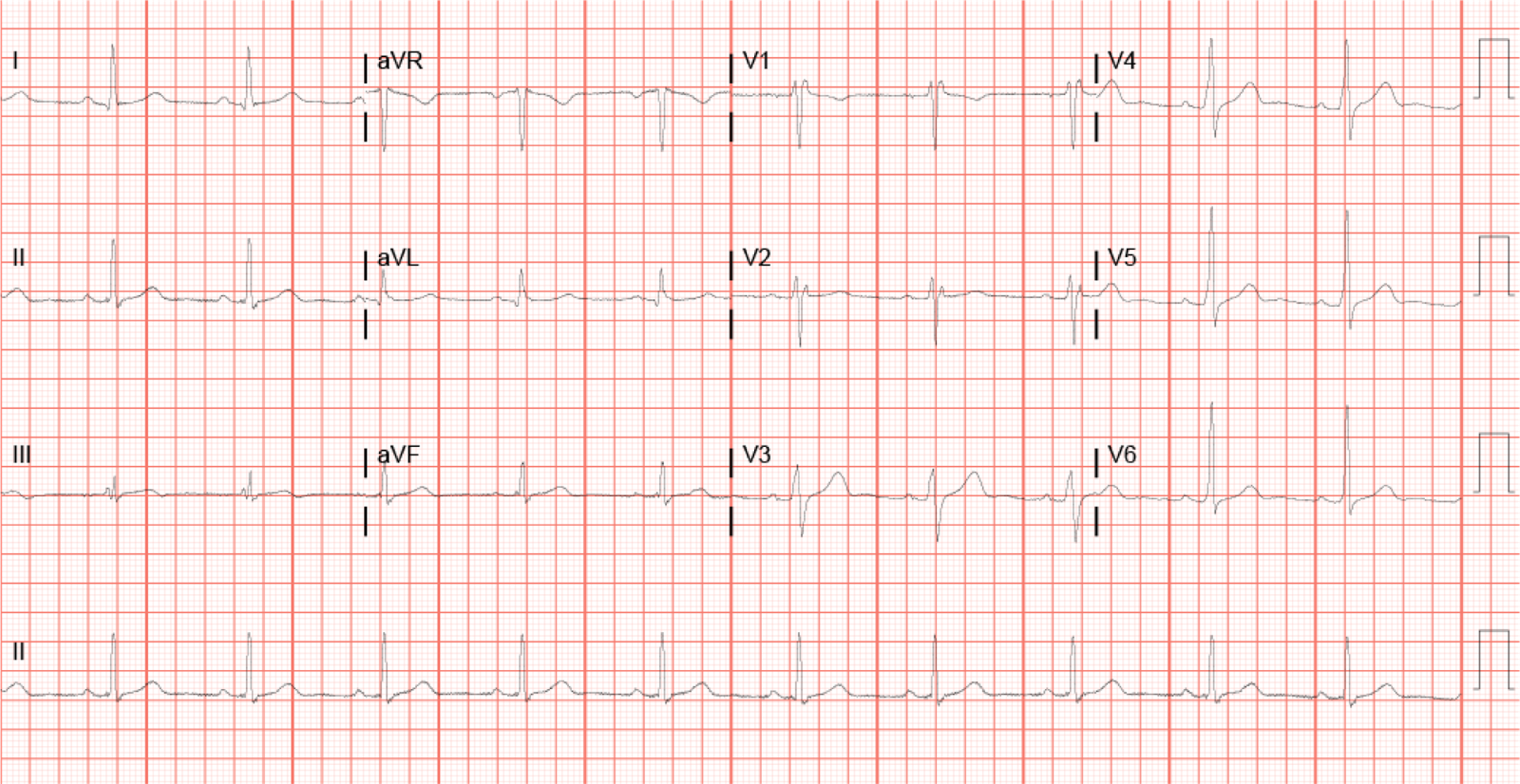 Dr. Smith's ECG Blog: Syncope Several Times, Complete Heart Block, And ...