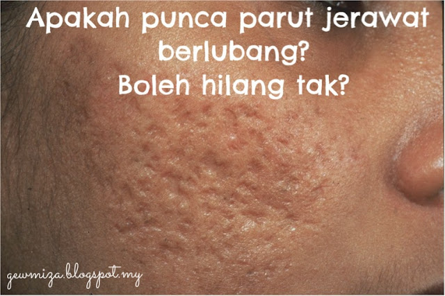 Parut Jerawat Berlubang di Muka, Apakah Punca dan Cara Mengatasinya ...