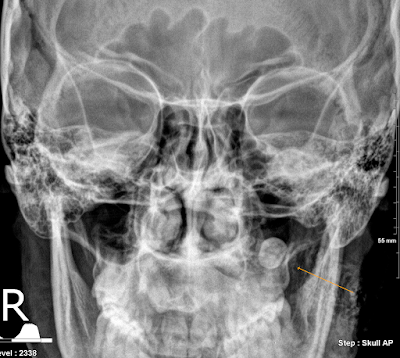 Antrolith: Plain Xray - Sumer's Radiology Blog