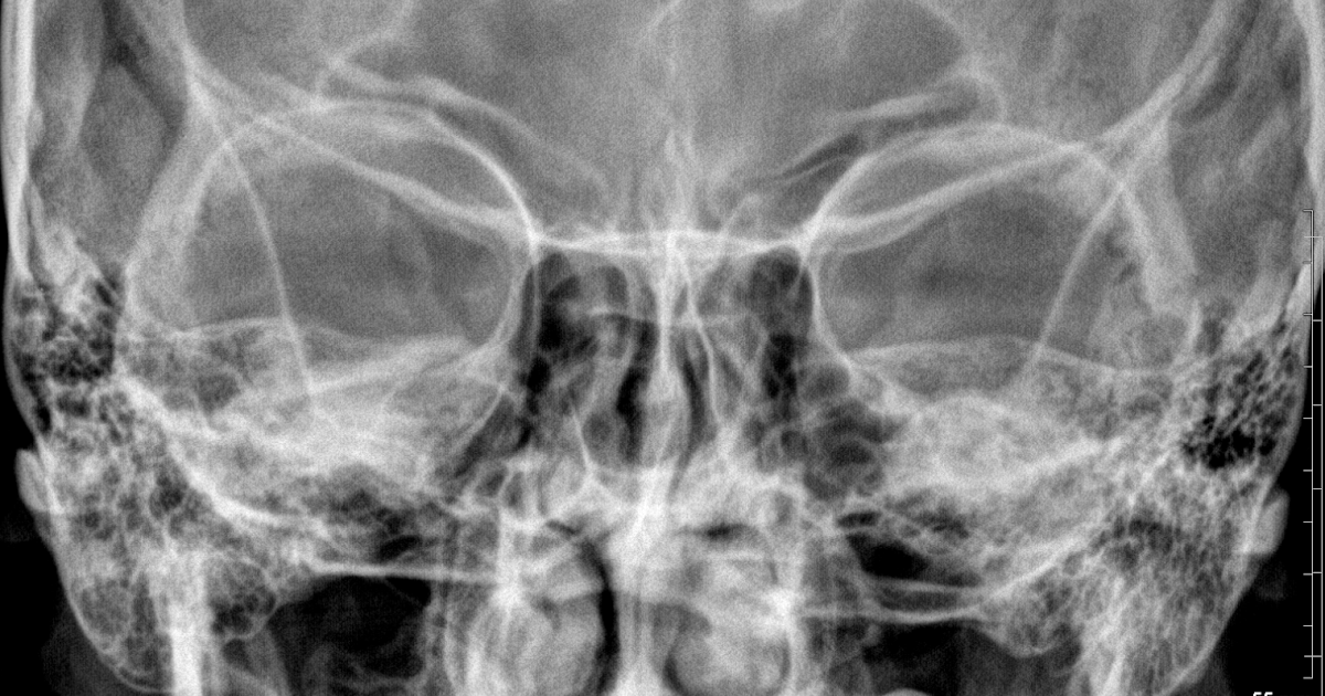 Antrolith: Plain Xray - Sumer's Radiology Blog