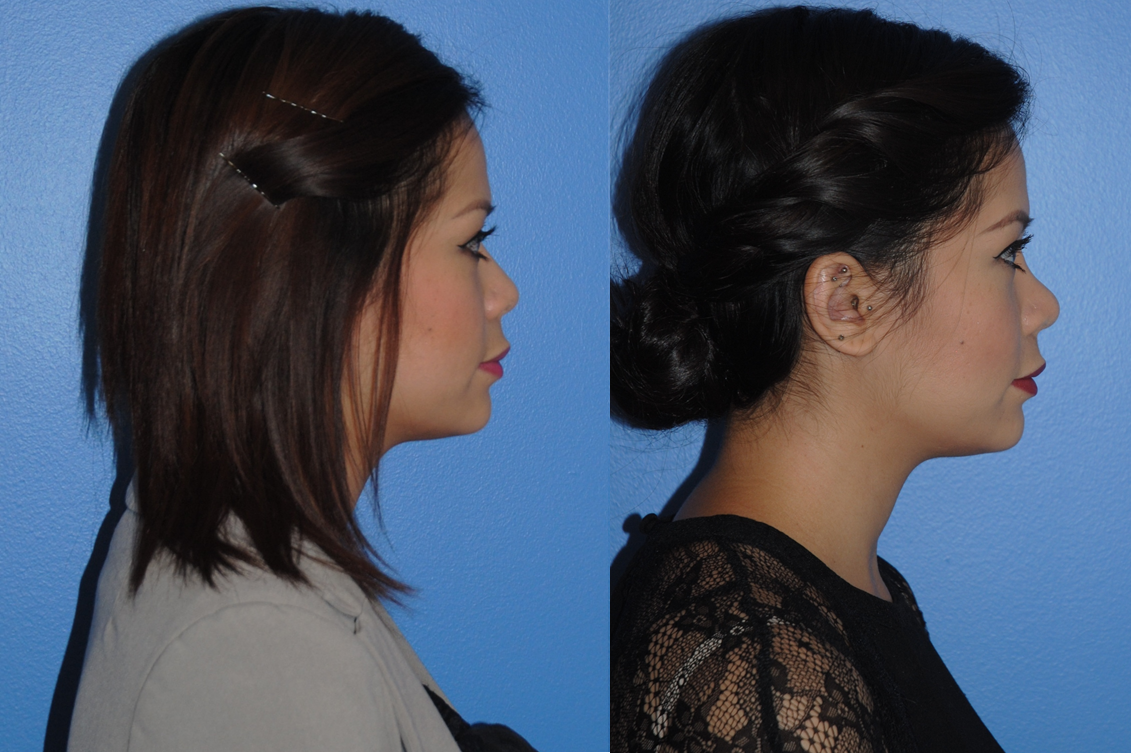 Rhinoplasty & Airway Reconstruction: Temporalis Fascia Graft for Radix ...