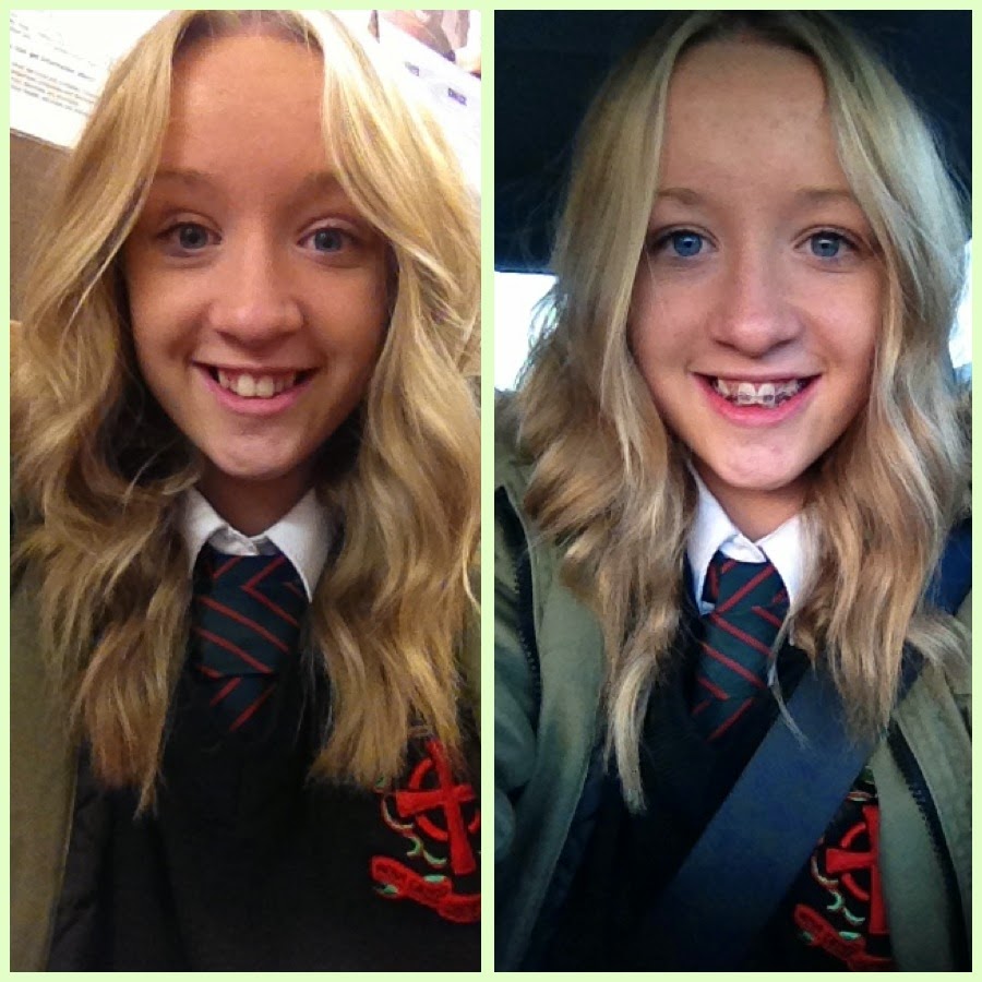 Hannah Malone: Braces - My Story