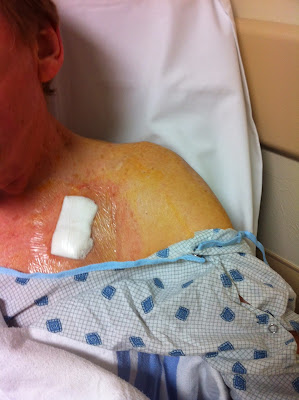 Joyful Expressions: Staples OUT, Mediport IN, Happy Me!