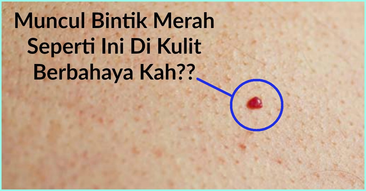 Muncul Bintik Merah Di Kulit Badan, Berbahaya Apa Tidak Ya ?? Begini ...