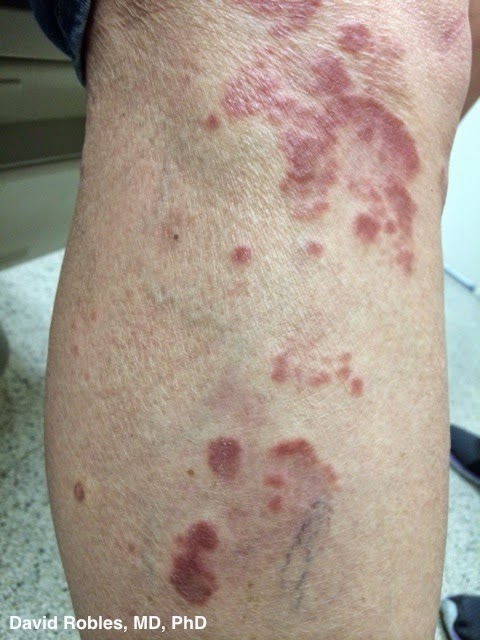 Granuloma Annulare: A Harmless Ring-like Rash that Can Mimic Ringworm