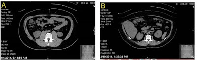 Utilization of Milk as an Oral Contrast Agent in CT Scan of the Abdomen ...