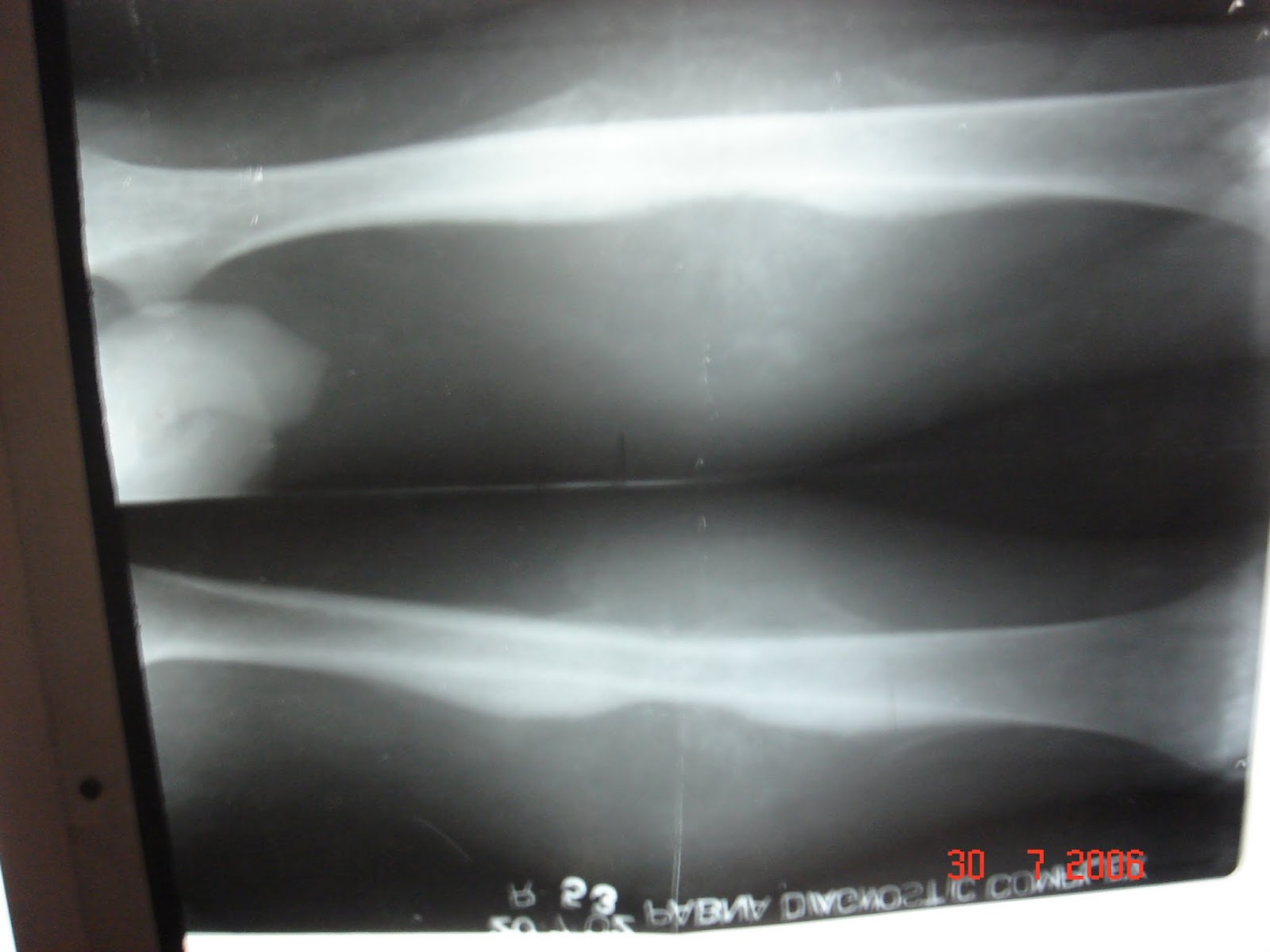 X-rays and Slides: x-ray of an ewing's sarcoma in femur