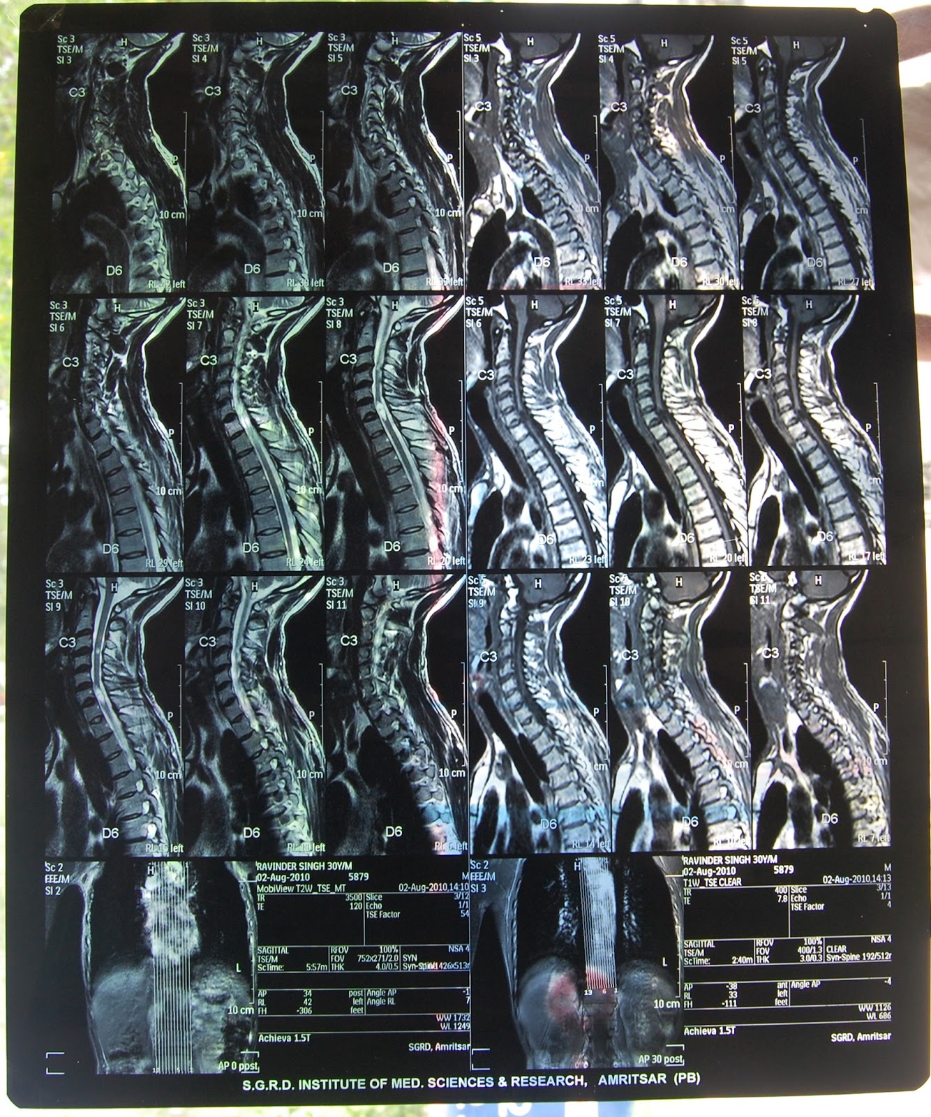 MY Spinal Cord Injury: MY MRI REPORTS