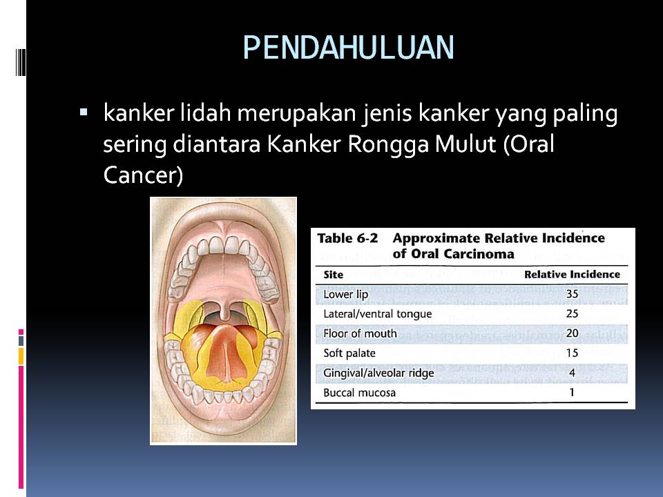 KEDOKTERAN - KEDOKTERAN GIGI: KANKER LIDAH