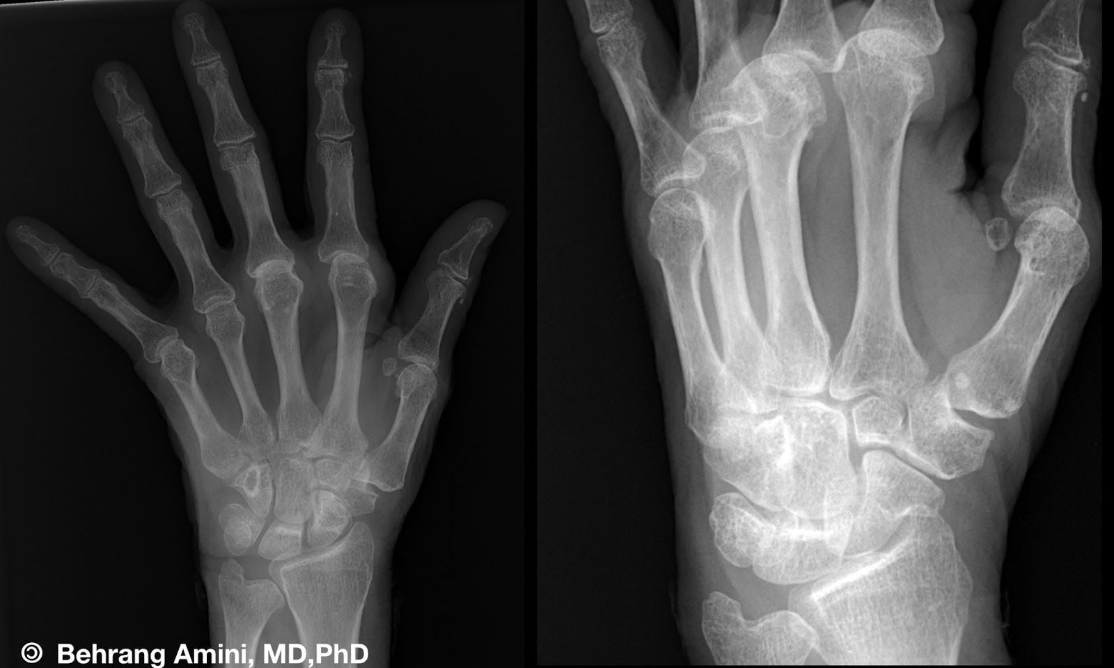 Roentgen Ray Reader: Hemochromatosis: Hand Manifestations