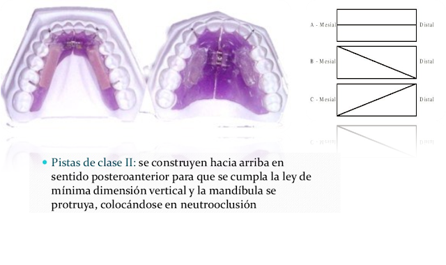 MALOCLUSIONES CLASE II