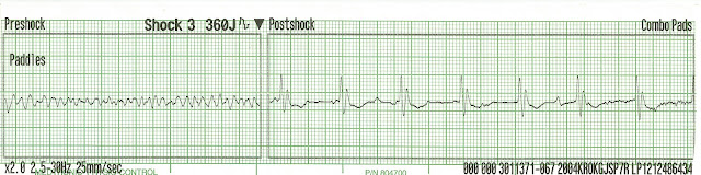 Pulseless VF/VT Part 3