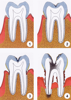 andar punya cerita: Karies Dentis