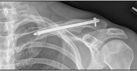 Clavicle Fracture Treatment | Clavicle Bone Fracture Surgery