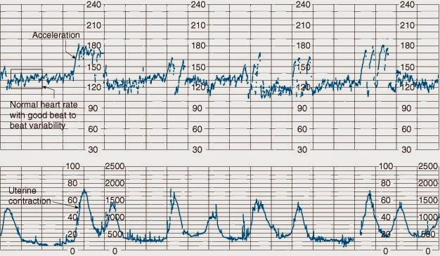 hEiDiMatEs - MeDICinE: Management of normal labour
