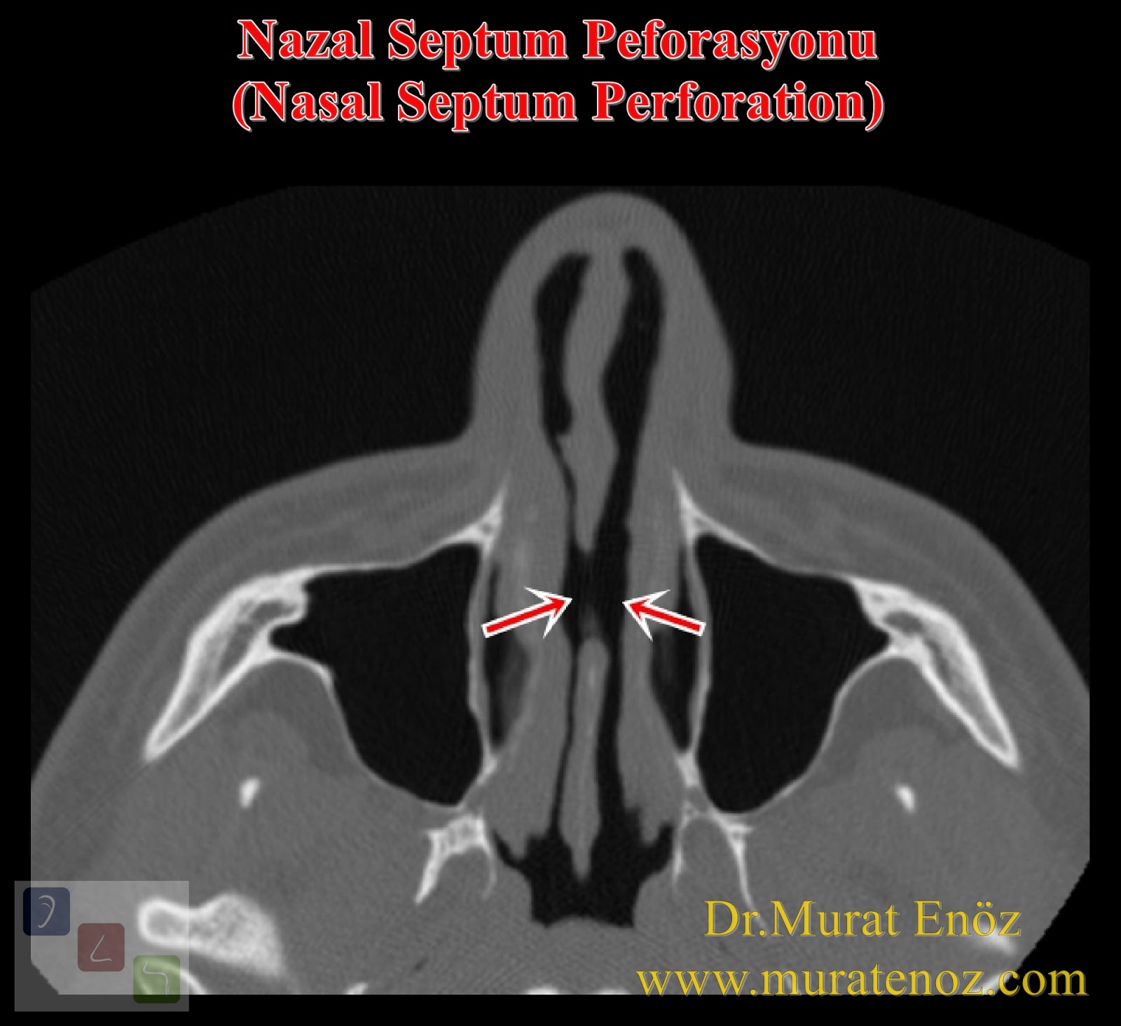 Repair of Large Septum Perforation With Rib Cartilage