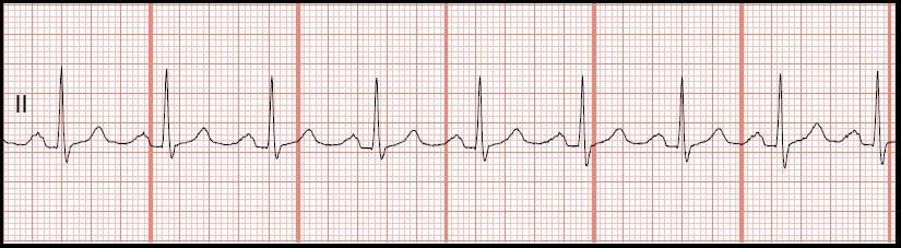 EKG Rhythm Strip Quiz 96: Sinus rhythms