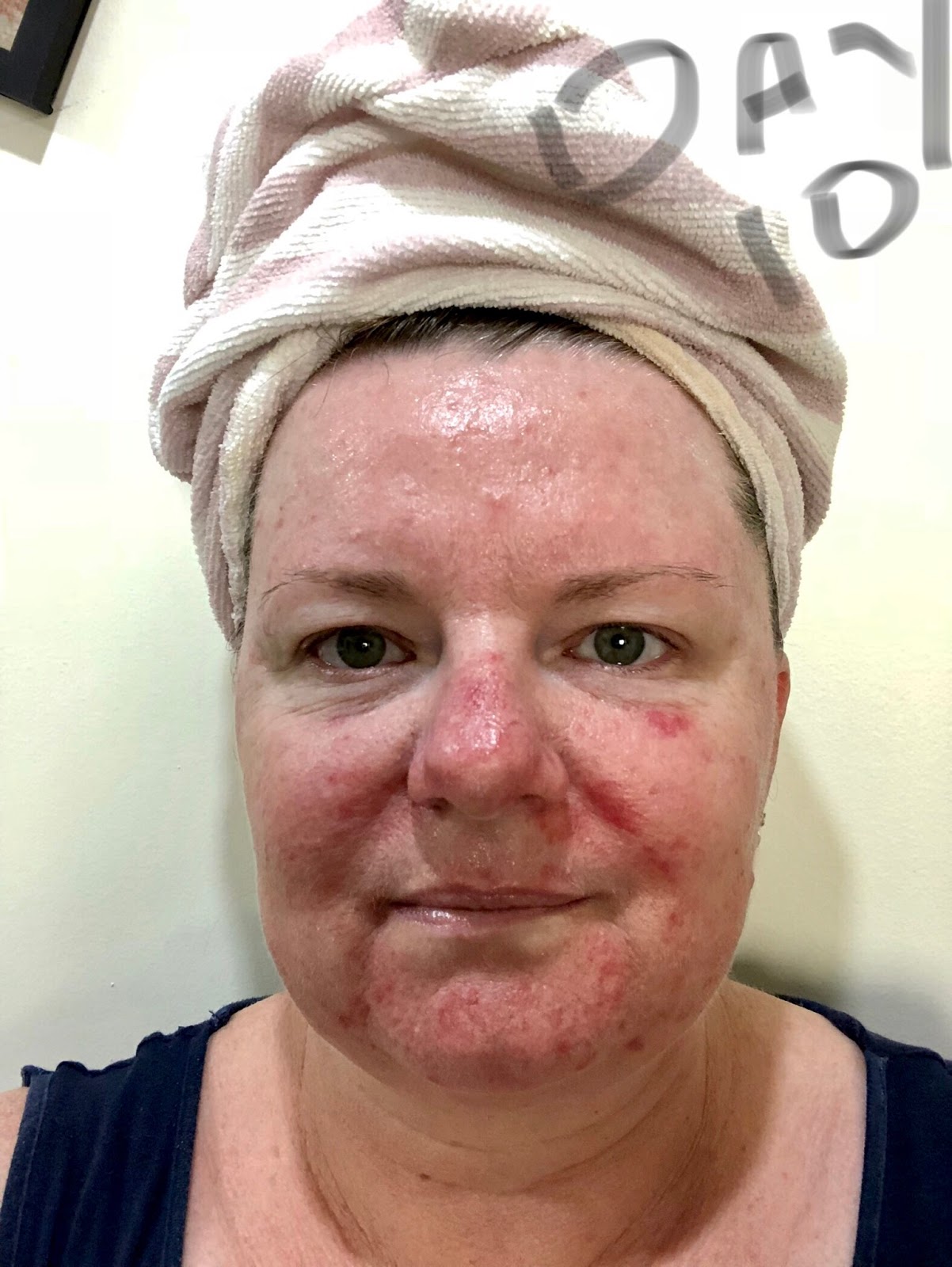 Efudix Treatment November 2018