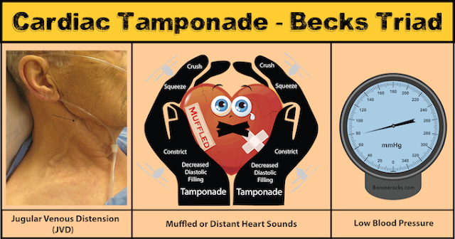 Beck's triad ~ MedstudCT
