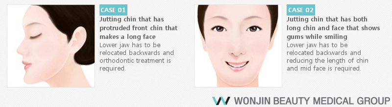 Korea Two Jaw Surgery Wonjin Beauty Medical Group - Jutting Jaw ...