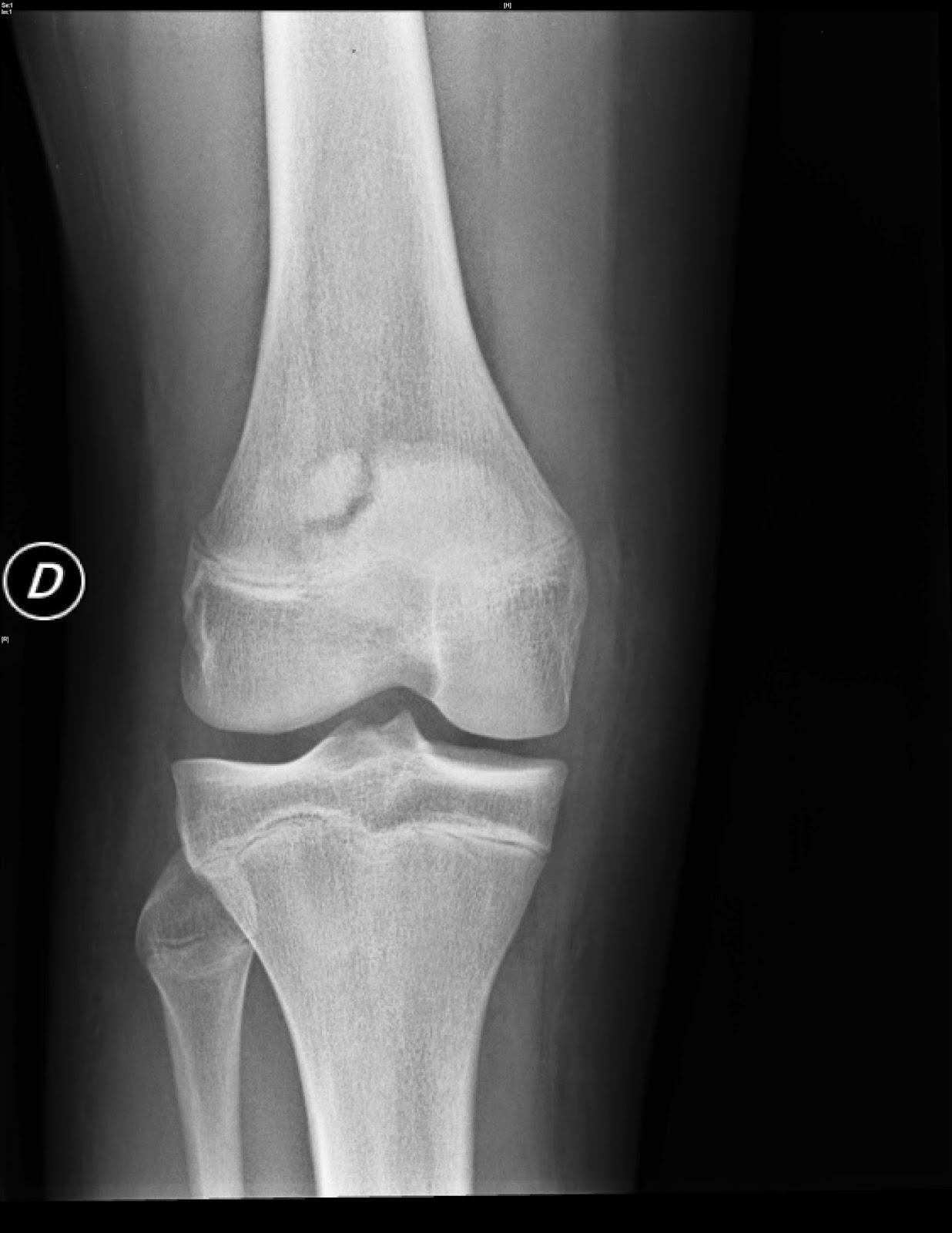 Docencia Alto Palancia: Rótula Bipartita.IMAGEN DOCENTE.