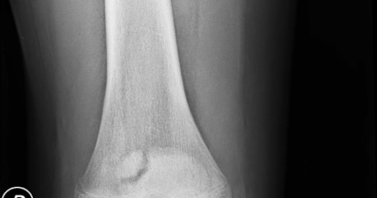 Docencia Alto Palancia: Rótula Bipartita.IMAGEN DOCENTE.