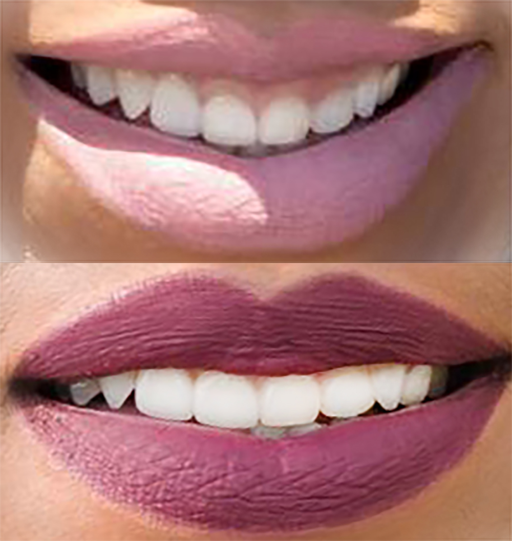 Smile Bright Teeth Whitening | Fashionably Idu