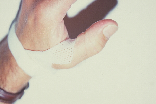 Orthèses Main-Poignet Lyon : Neurologie, bilan sensitif et orthèses