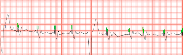 Basic EKG Rhythm Test 35