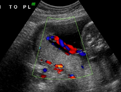 Velamentous Cord Insertion Ultrasound